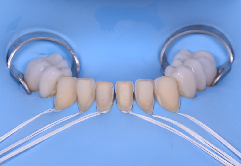 The multi-luting concept: a new approach to facilitate the adhesive ...