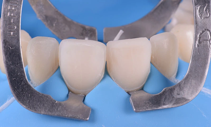 The multi-luting concept: a new approach to facilitate the adhesive ...